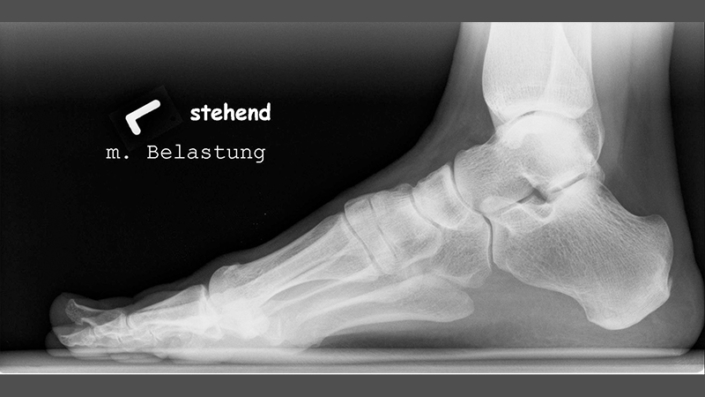 Scarf Osteotomie Operation – Hallux valgus: Scarf-Osteotomie Surgical ...