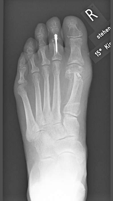 Arthrodese des Zehenmittelgelenks (PIP-Arthrodese) - OGAM Orthopädie