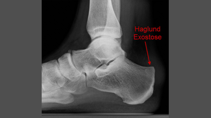 Haglund-Exostose – OGAM Orthopädie