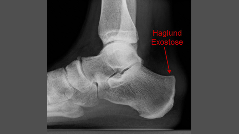 Haglund-Exostose – OGAM Orthopädie