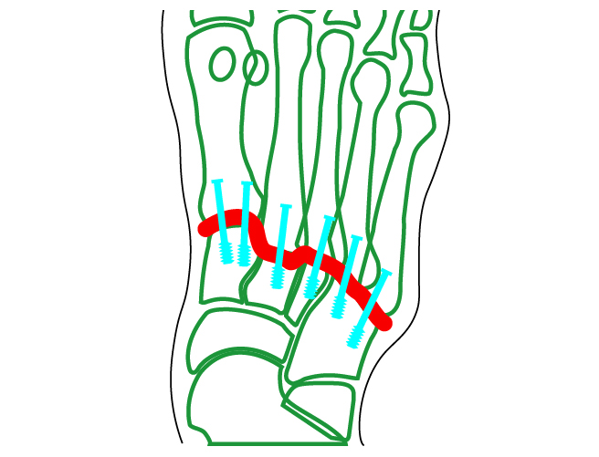 Knochenentnahme vom Beckenkamm - OGAM Orthopädie