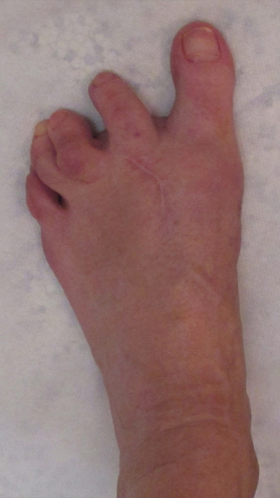 Hammerzehe - OGAM Orthopädie