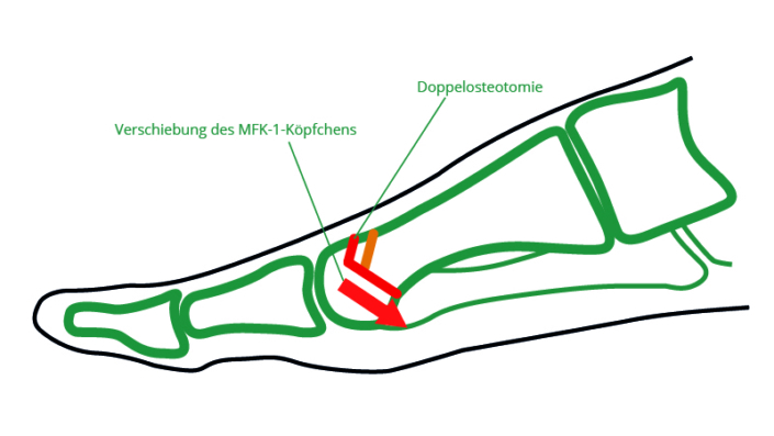 Youngswick-Operation - OGAM Orthopädie