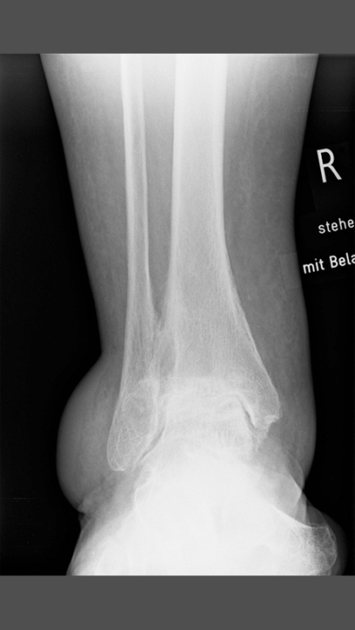 Arthrodese OSG - OGAM Orthopädie