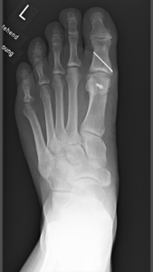 Moberg-Operation - OGAM Orthopädie