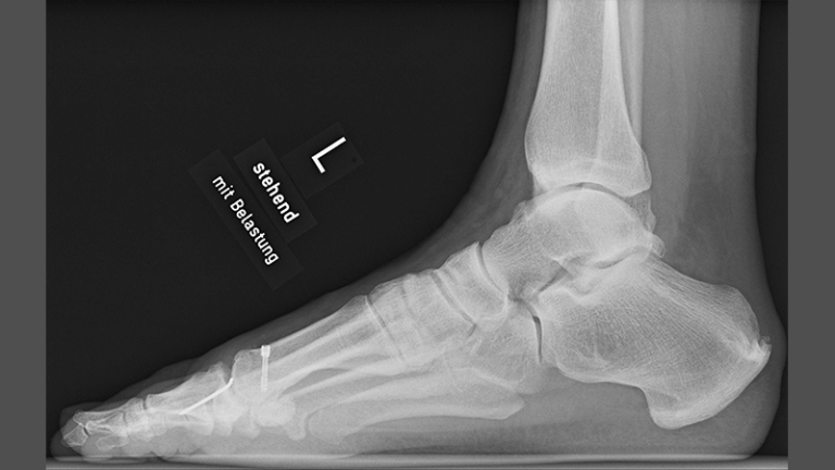 Youngswick-Operation - OGAM Orthopädie