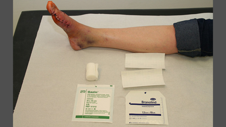 Wundheilung und Verbandswechsel – OGAM Orthopädie Wundheilung und Verbandswechsel – OGAM Orthopädie