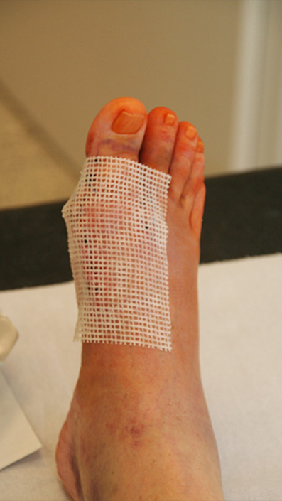 Wundheilung und Verbandswechsel – OGAM Orthopädie