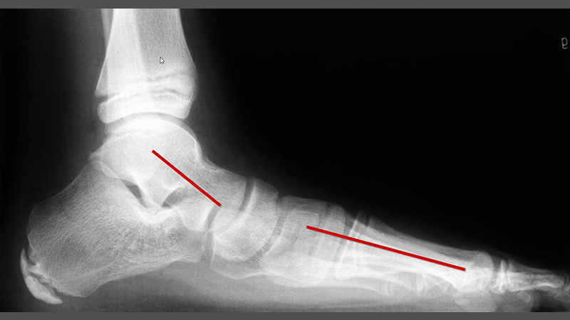 Kindlicher Knick-Senkfuß - OGAM Orthopädie