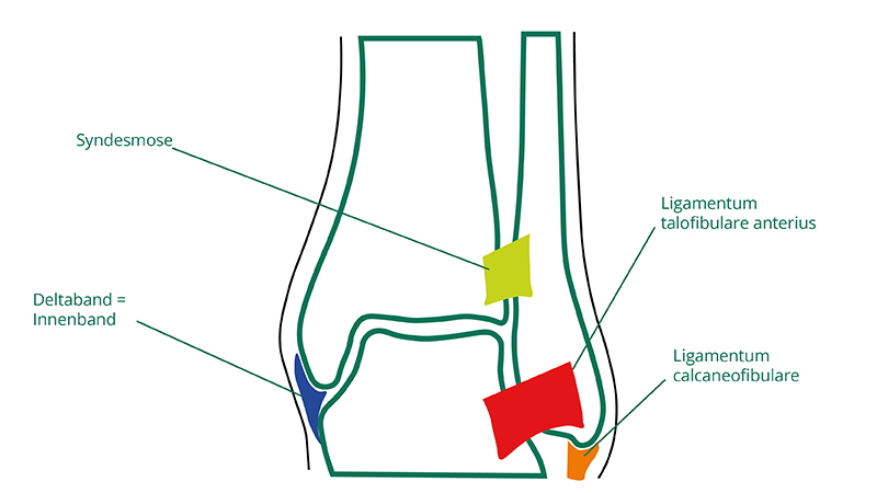 Syndesmosenruptur Osg , Syndesmosenriss – QVOC