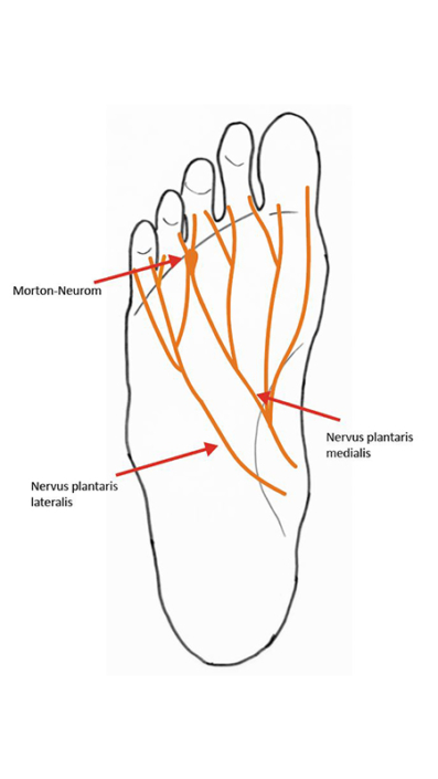 Morton-Neurom - OGAM Orthopädie