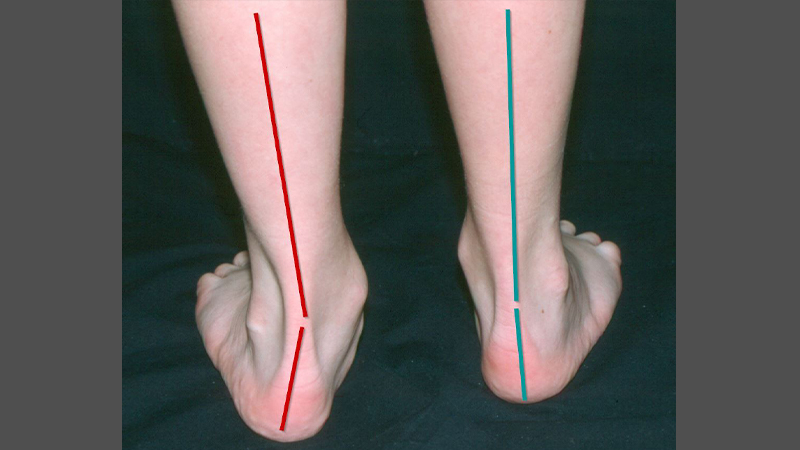 Kindlicher Knick-Senkfuß - OGAM Orthopädie