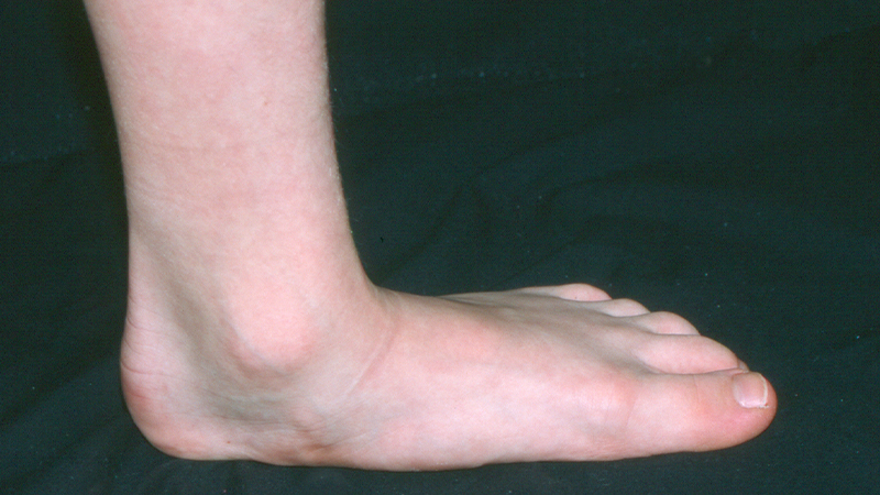Kindlicher Knick-Senkfuß - OGAM Orthopädie
