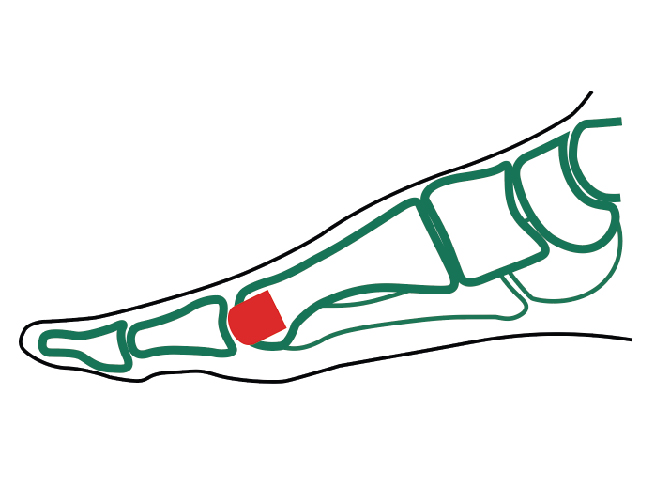 Hallux Rigidus Cartiva - OGAM Orthopädie