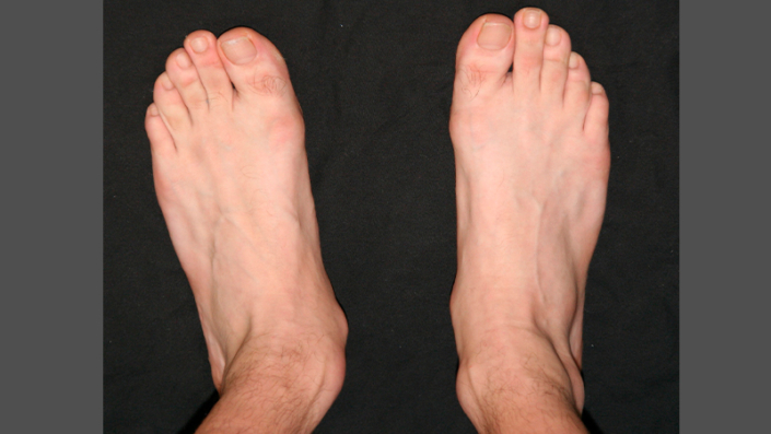 Knick-Senk-Fuß - OGAM Orthopädie