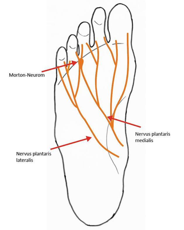 Morton-Neurom – Wuppertaler Fuß – Initiative