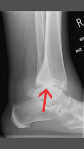 OSG Arthrose - OGAM Orthopädie