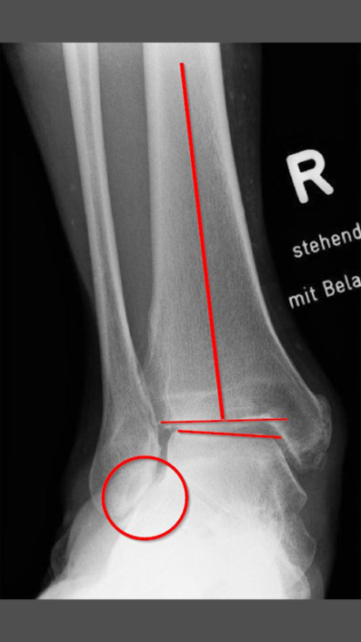 Umstellungs-Osteotomie OSG - OGAM Orthopädie