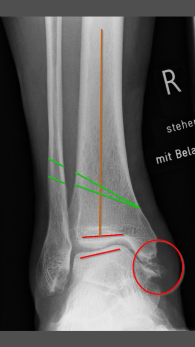 Umstellungs-Osteotomie OSG - OGAM Orthopädie