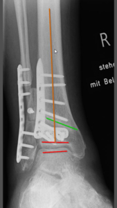 Umstellungs-Osteotomie OSG - OGAM Orthopädie