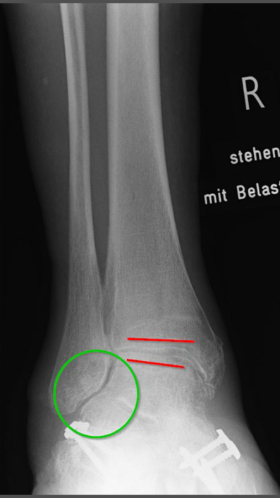 Umstellungs-Osteotomie OSG - OGAM Orthopädie