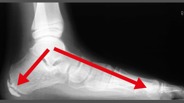 Kindlicher Knick-Senkfuß - OGAM Orthopädie