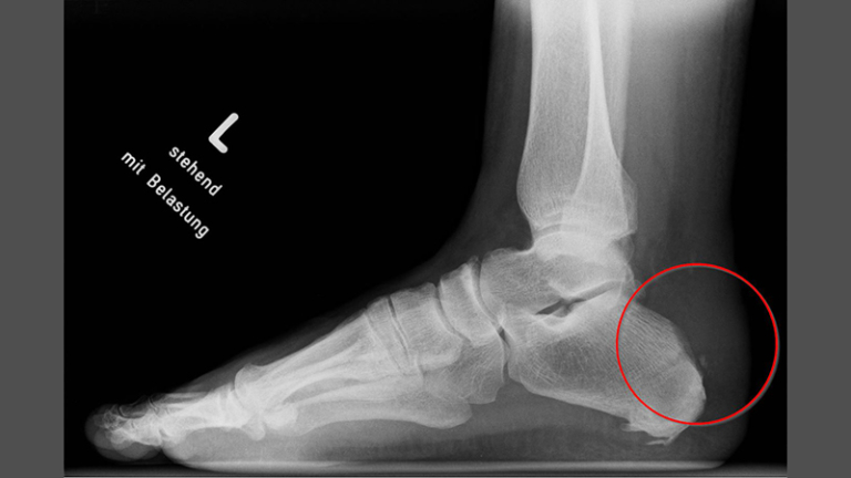 Chronische Insertionstendopathie - OGAM Orthopädie