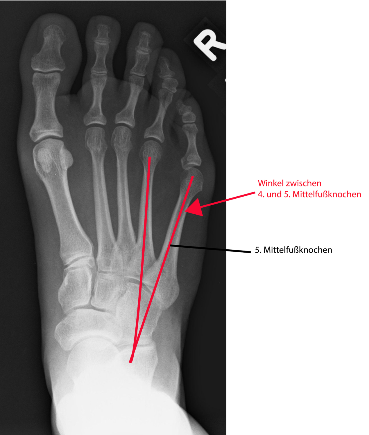 Schneiderballen - OGAM Orthopädie
