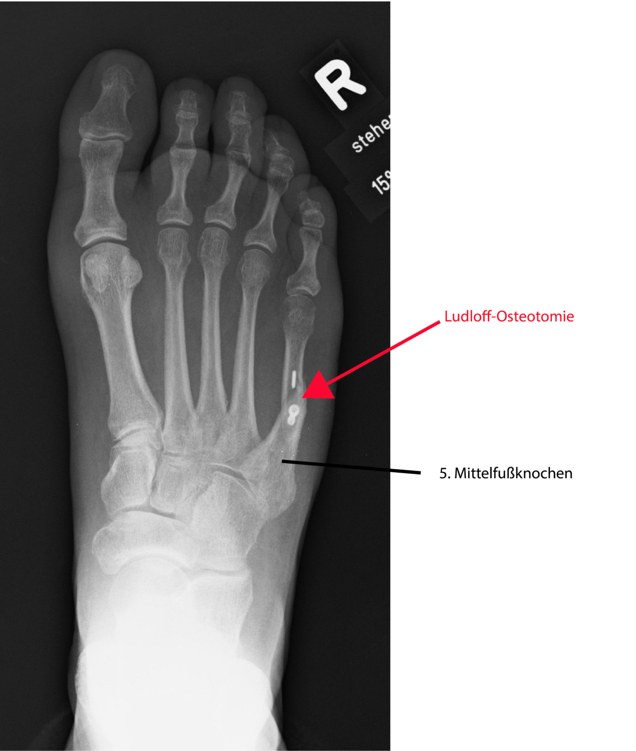 Schneiderballen - OGAM Orthopädie
