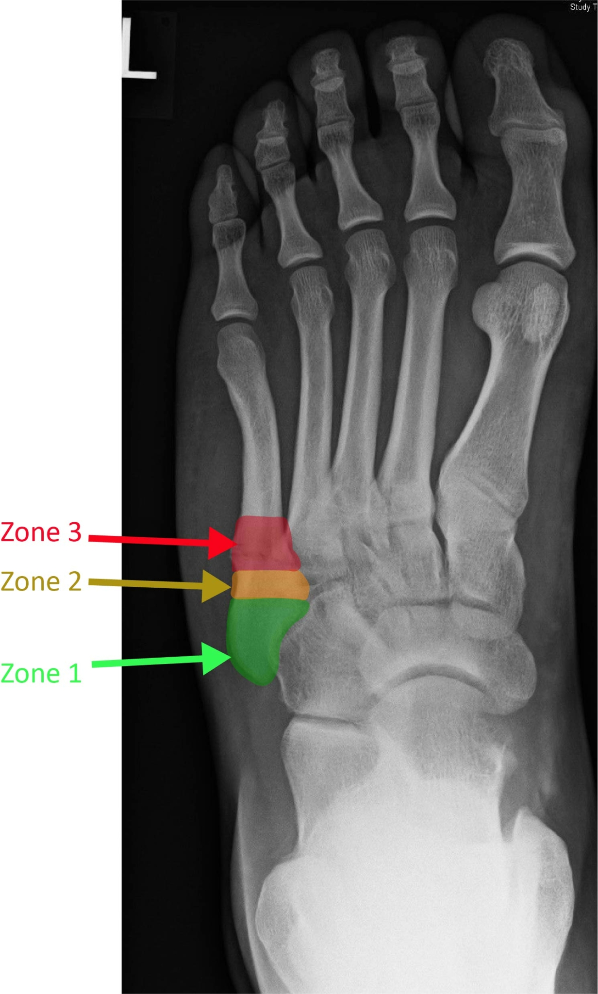 Fraktur 5. Mittelfußknochen - OGAM Orthopädie