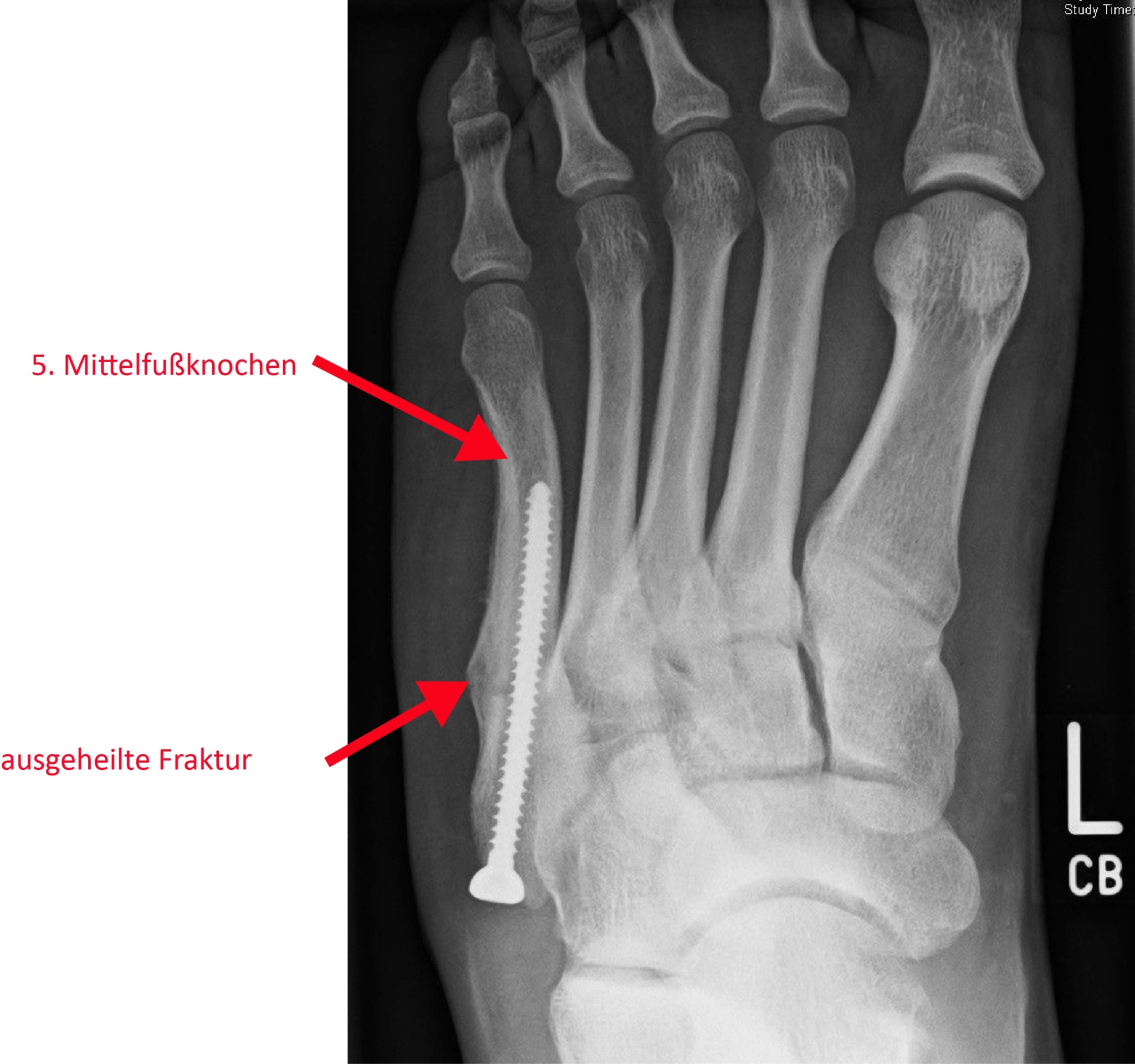 Fraktur 5. Mittelfußknochen - OGAM Orthopädie