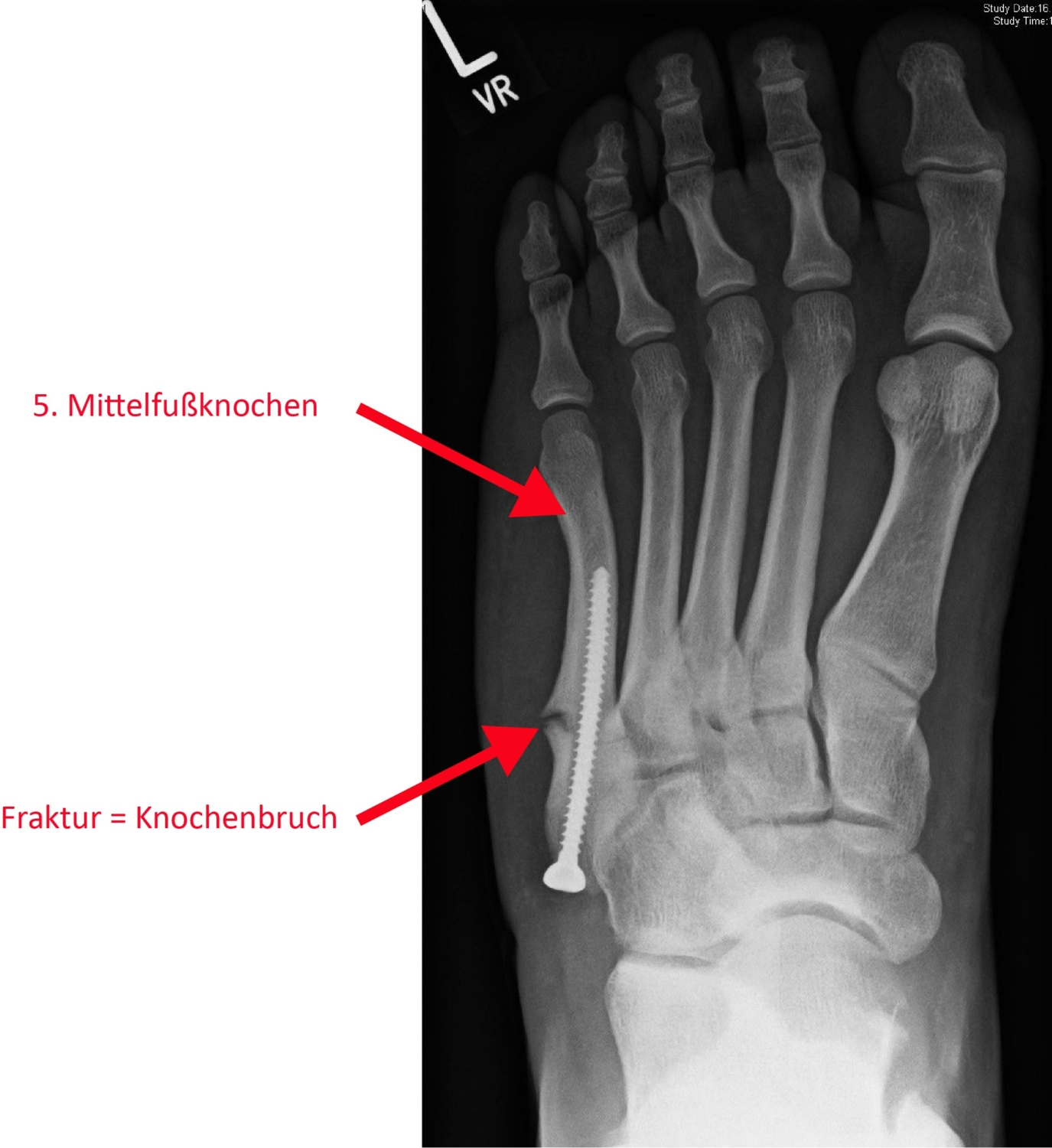 Fraktur 5. Mittelfußknochen - OGAM Orthopädie