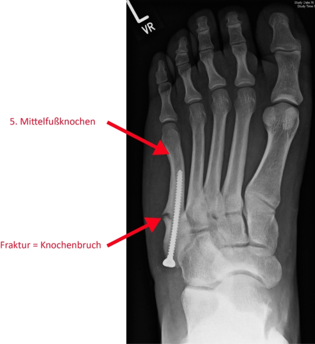 Fraktur 5. Mittelfußknochen - OGAM Orthopädie
