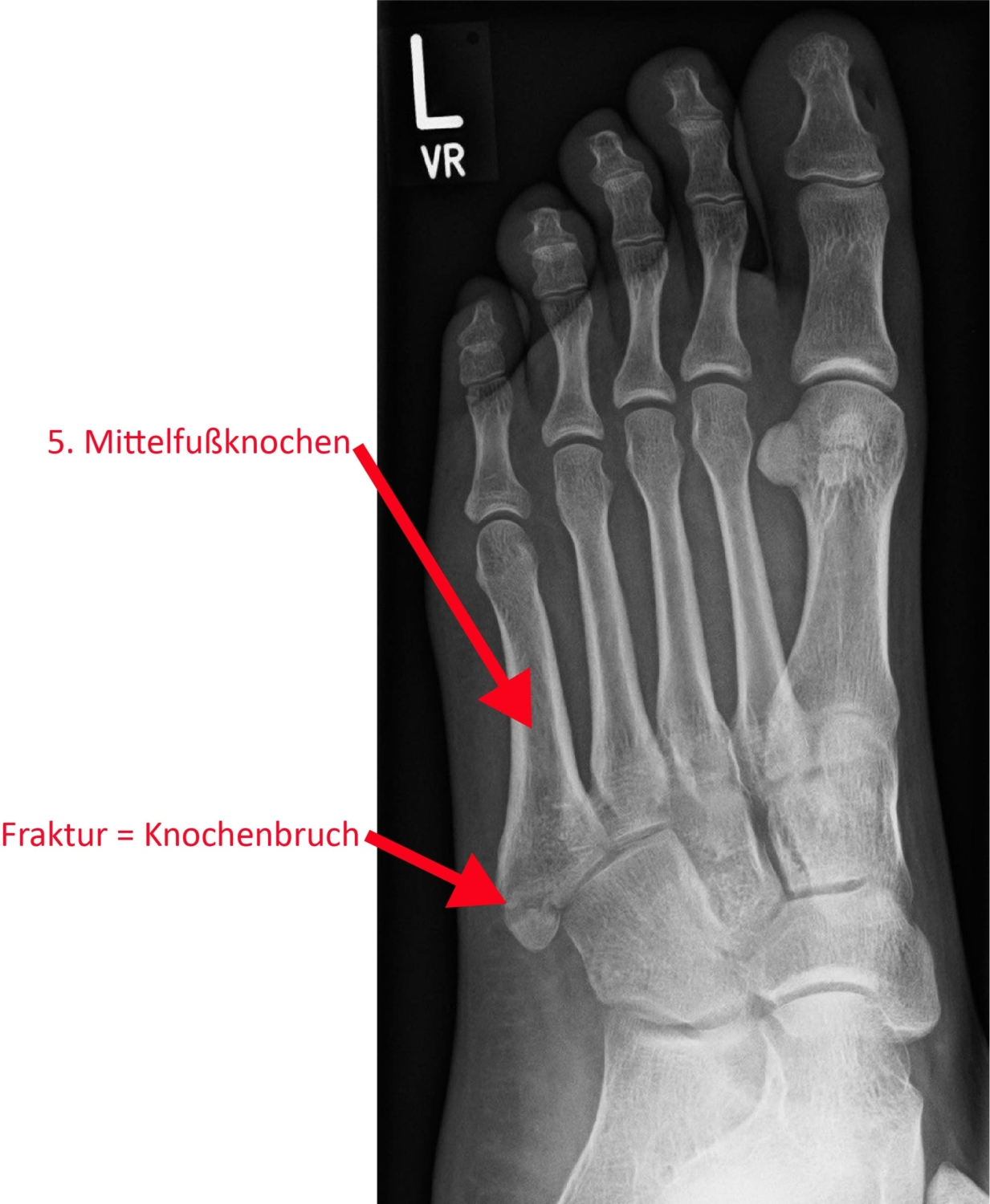 Fraktur 5. Mittelfußknochen - OGAM Orthopädie